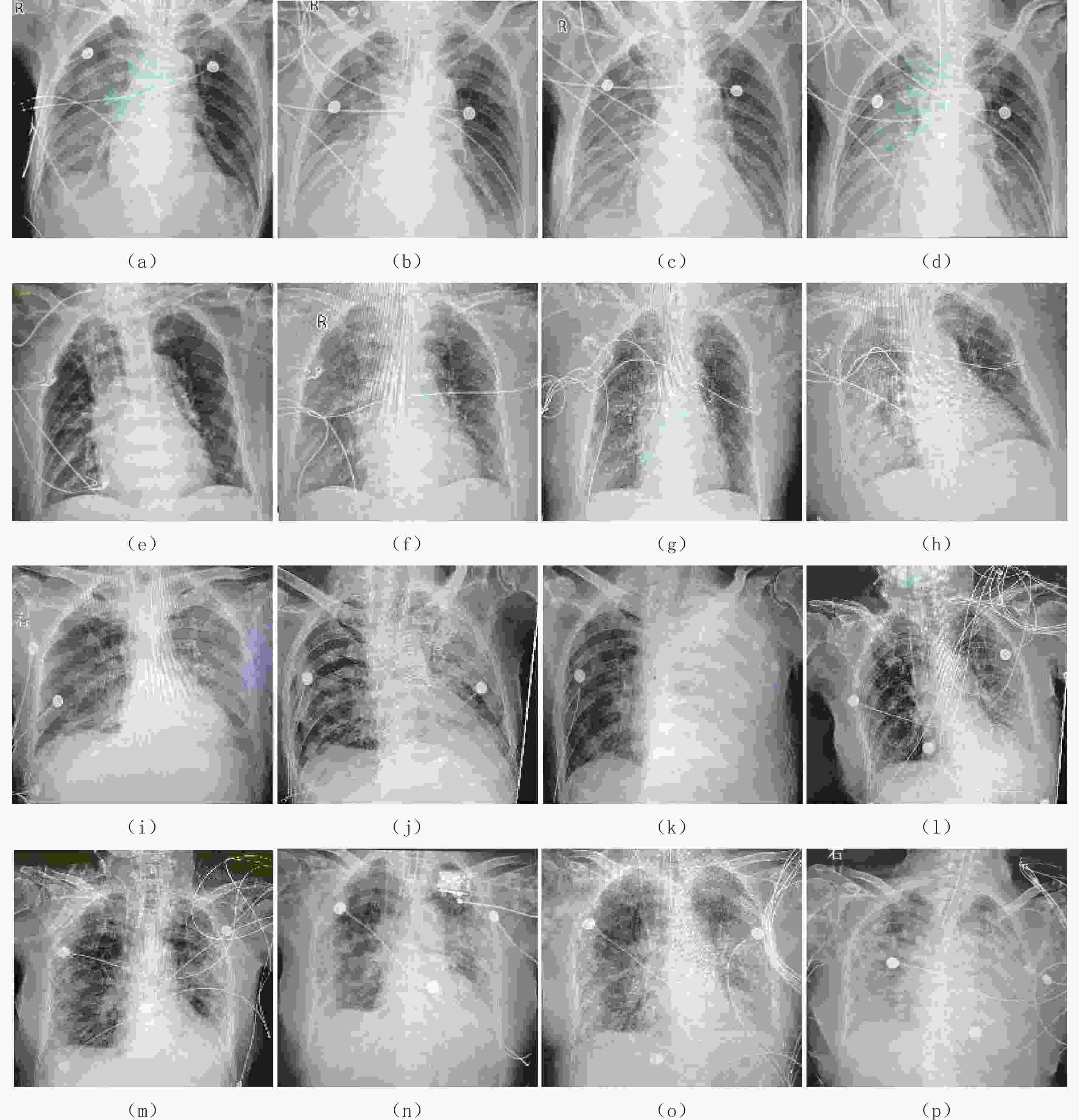 The Value of Digital DR Bedside Chest Radiography and Chest CT Scanning ...